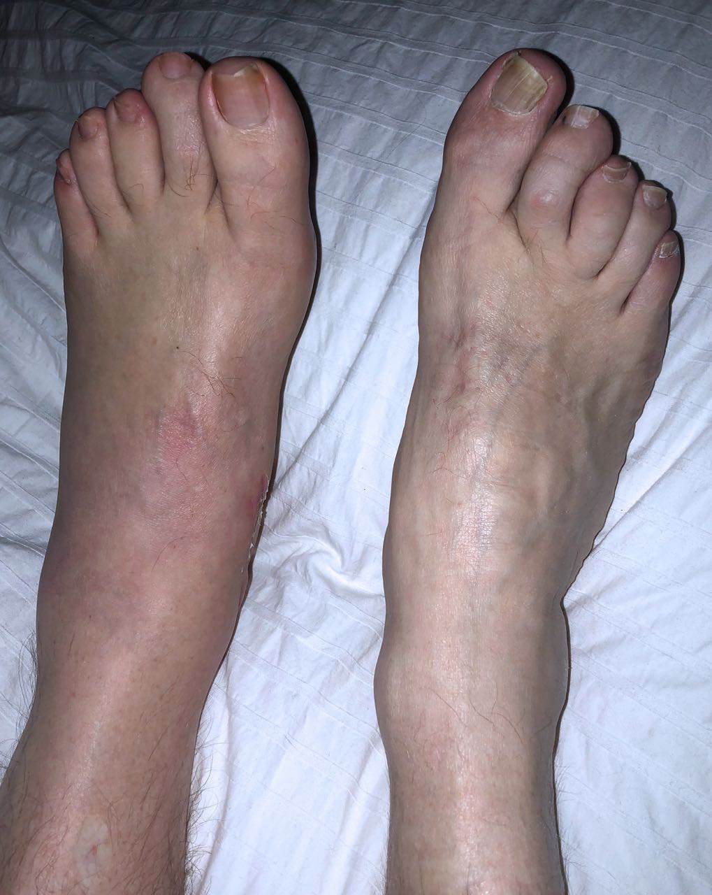 Week 4-5 – My Flatfoot Surgery Recovery